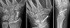 주상골 골절scaphoid Fracture 넘어진 뒤에 엄지 손가락 쪽 손목이 아파요 네이버 블로그
